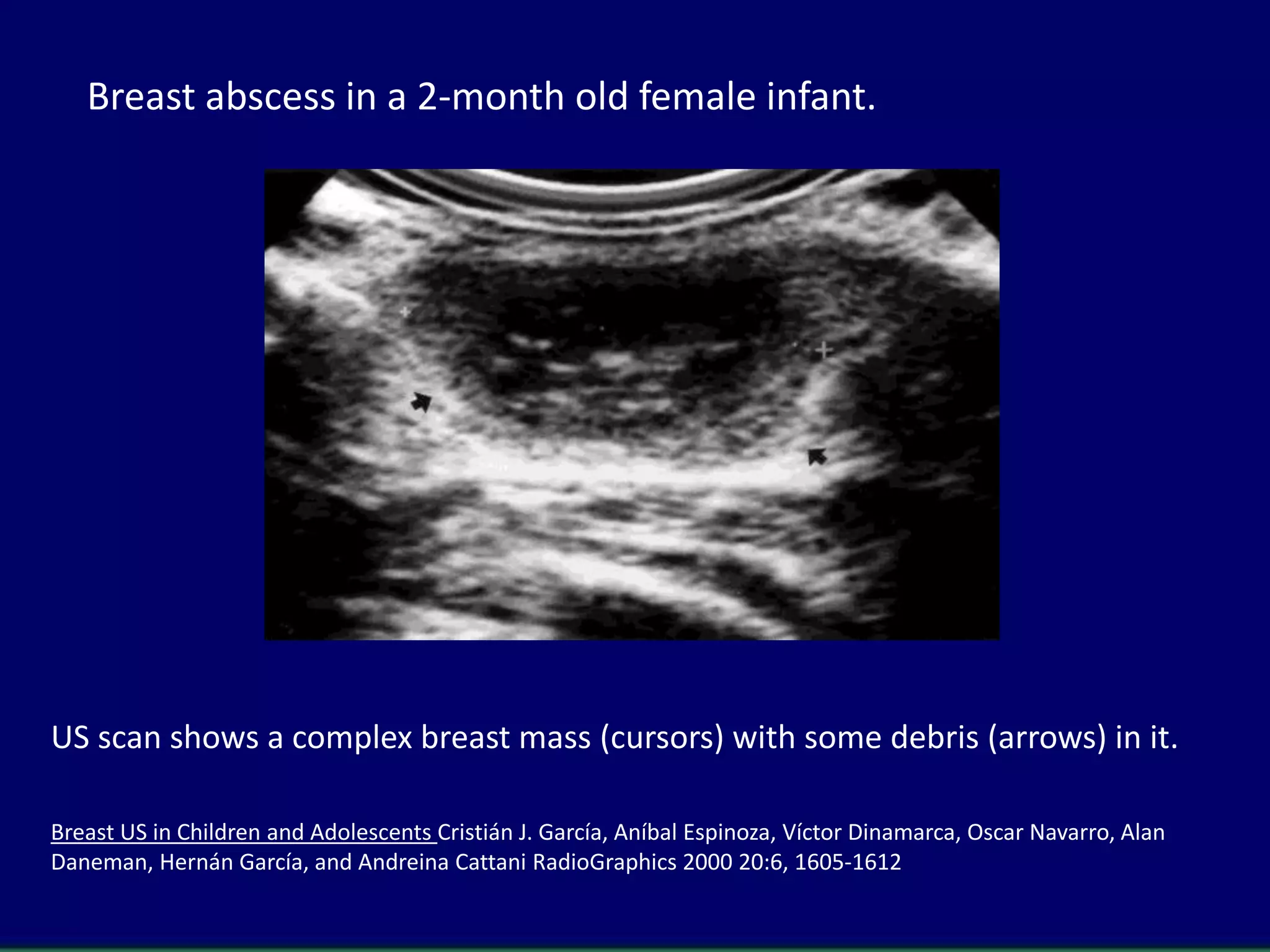 Ultrasound of pediatric and adolescent breast | PPTX