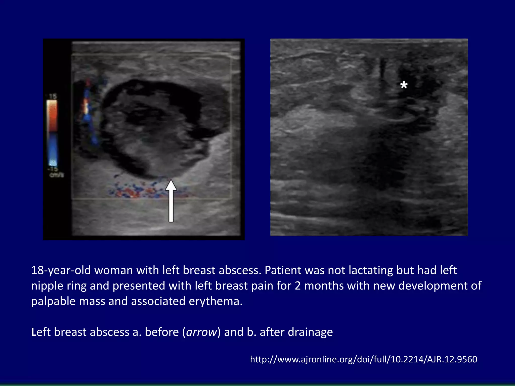 Ultrasound of pediatric and adolescent breast | PPTX