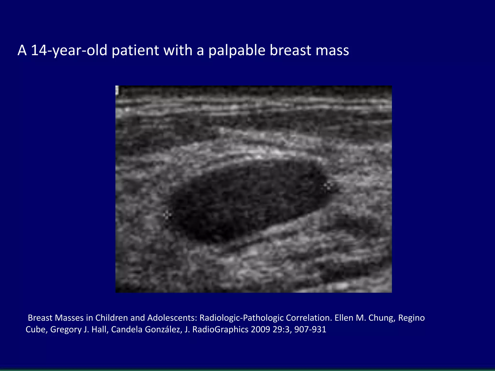 Ultrasound of pediatric and adolescent breast | PPTX