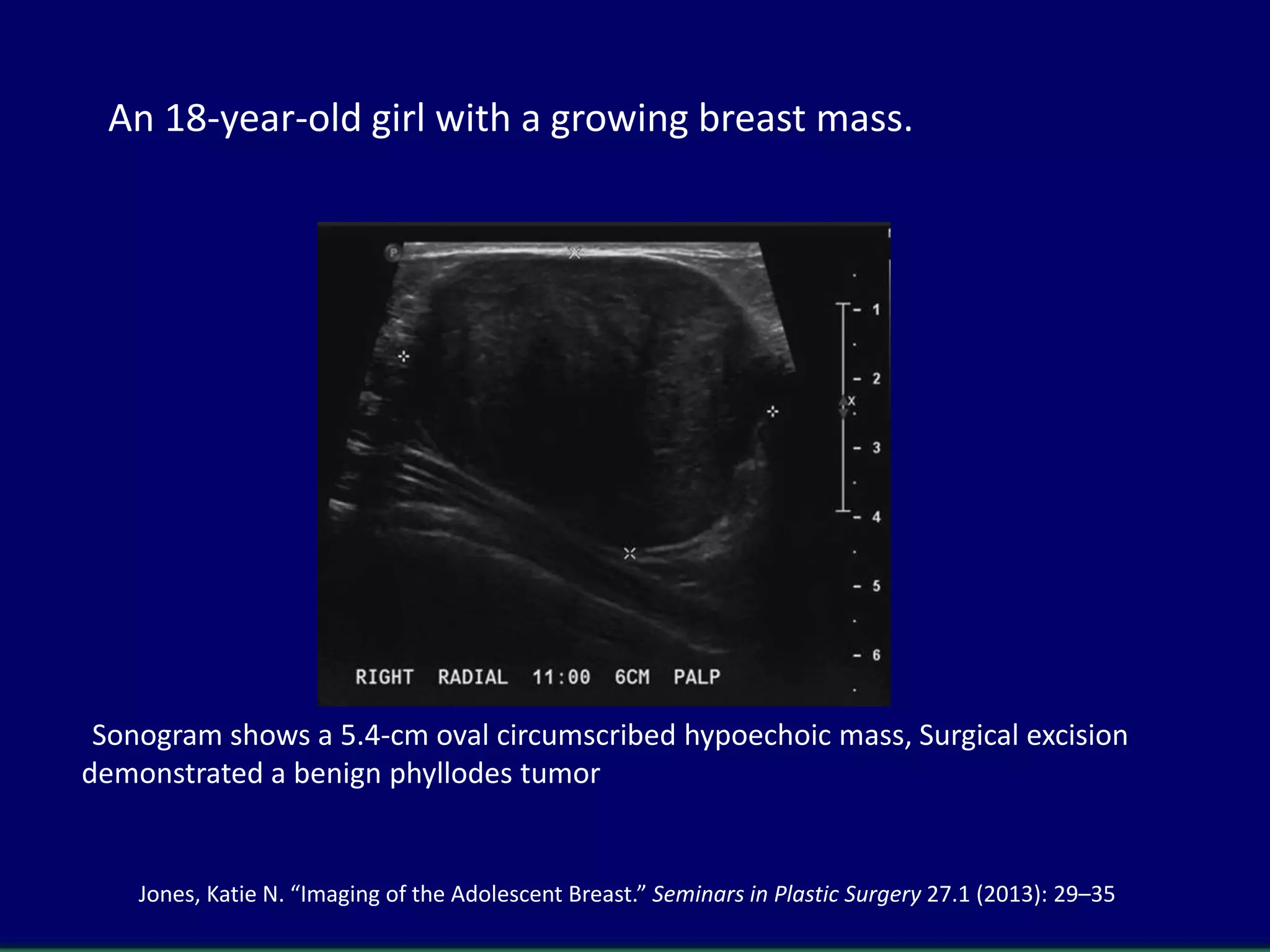 Ultrasound of pediatric and adolescent breast | PPTX
