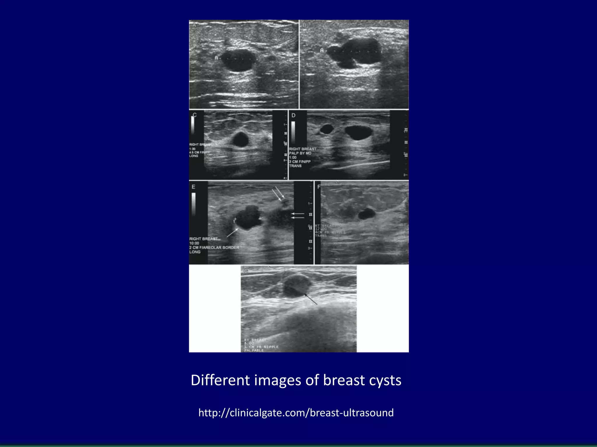 Ultrasound of pediatric and adolescent breast | PPTX
