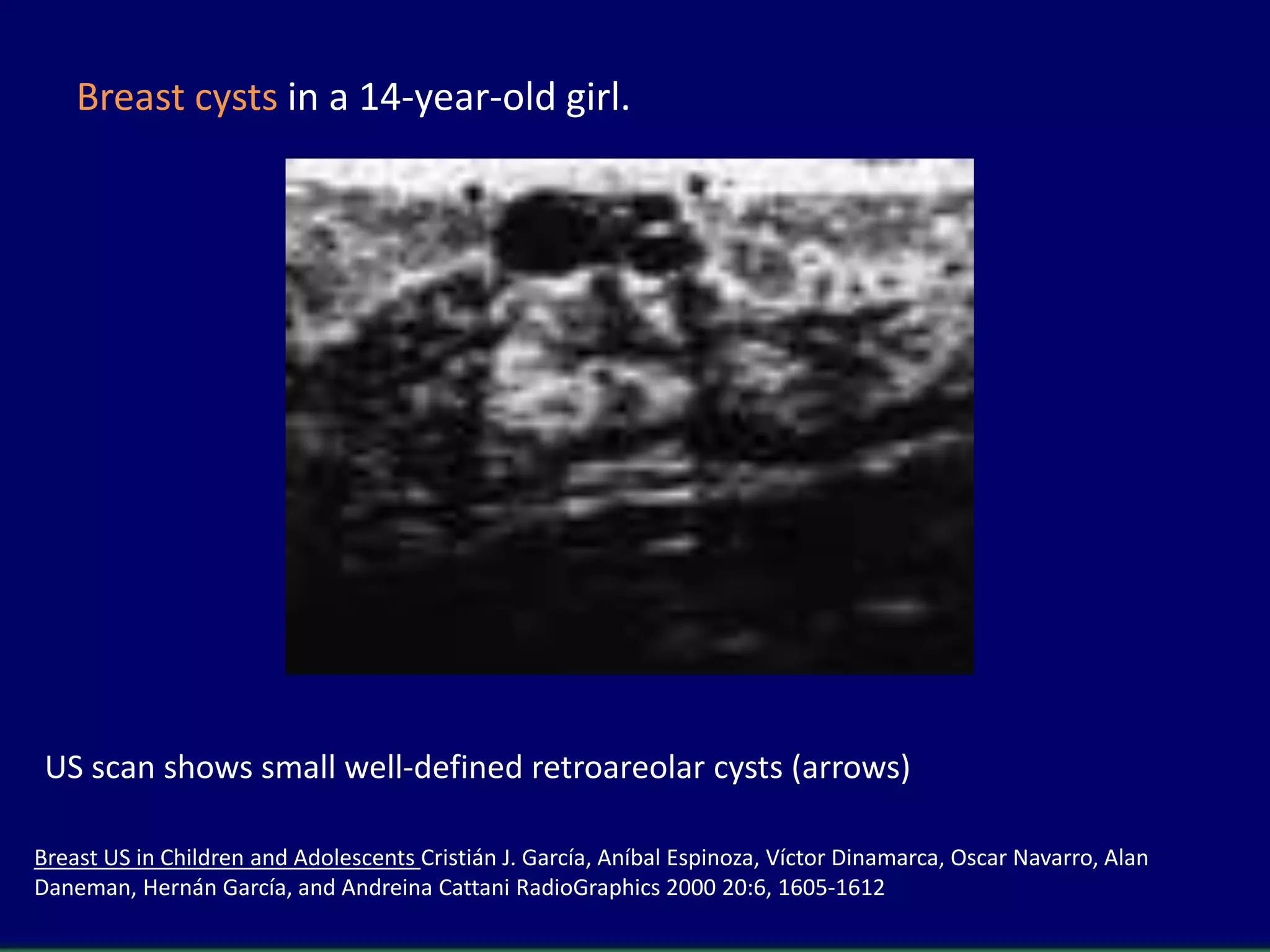 Ultrasound of pediatric and adolescent breast | PPTX