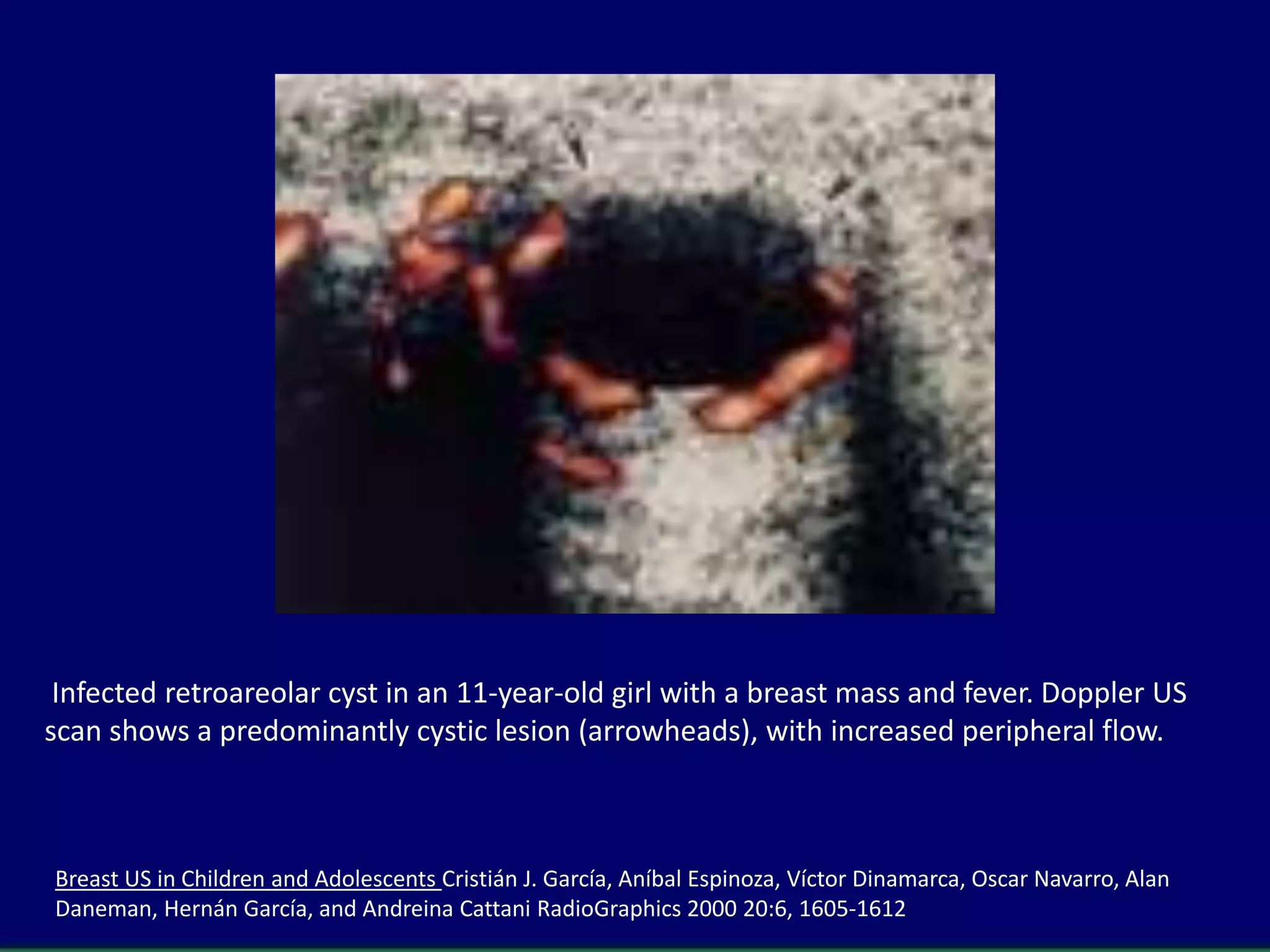 Ultrasound of pediatric and adolescent breast | PPTX