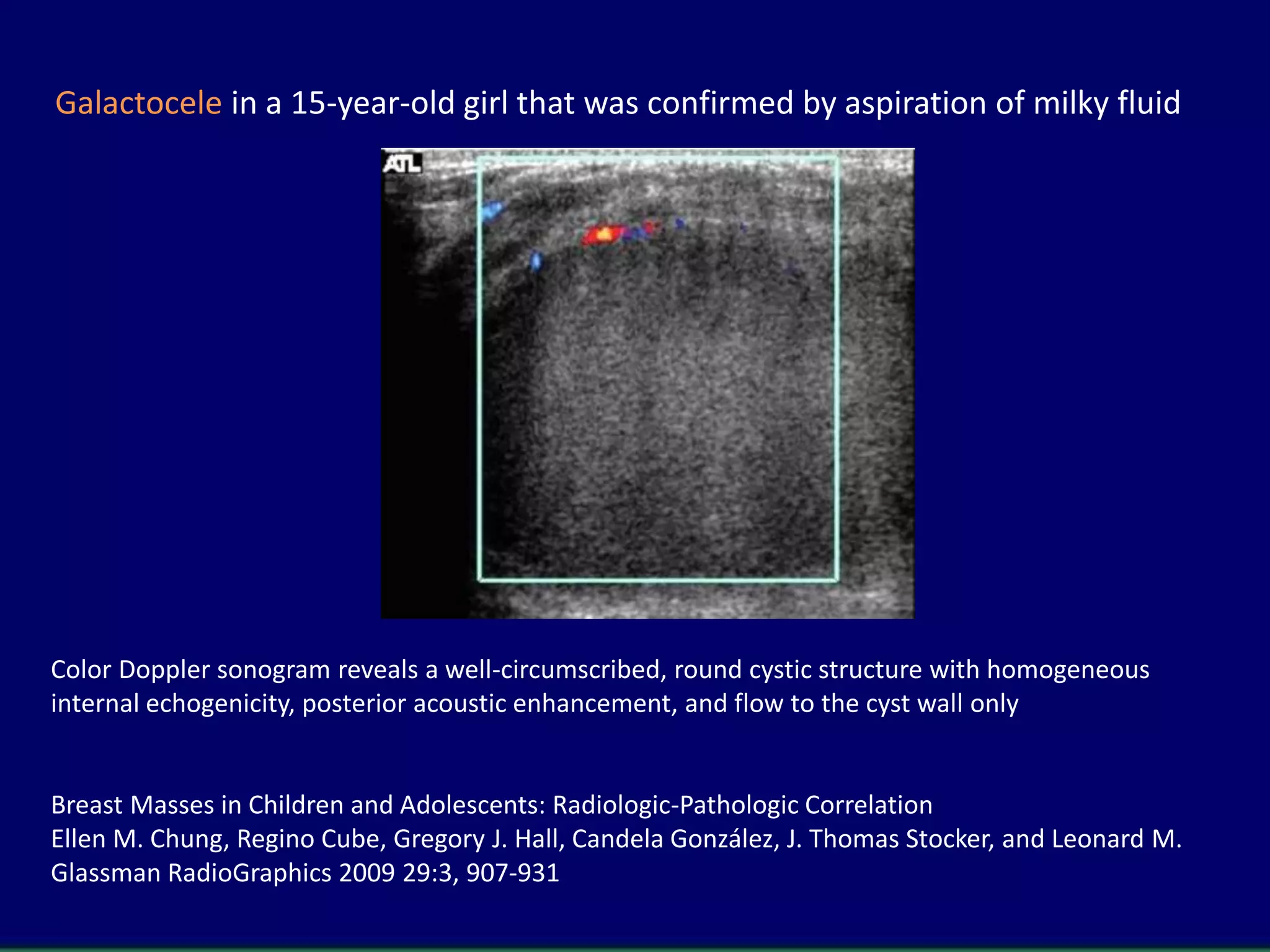 Ultrasound of pediatric and adolescent breast | PPTX
