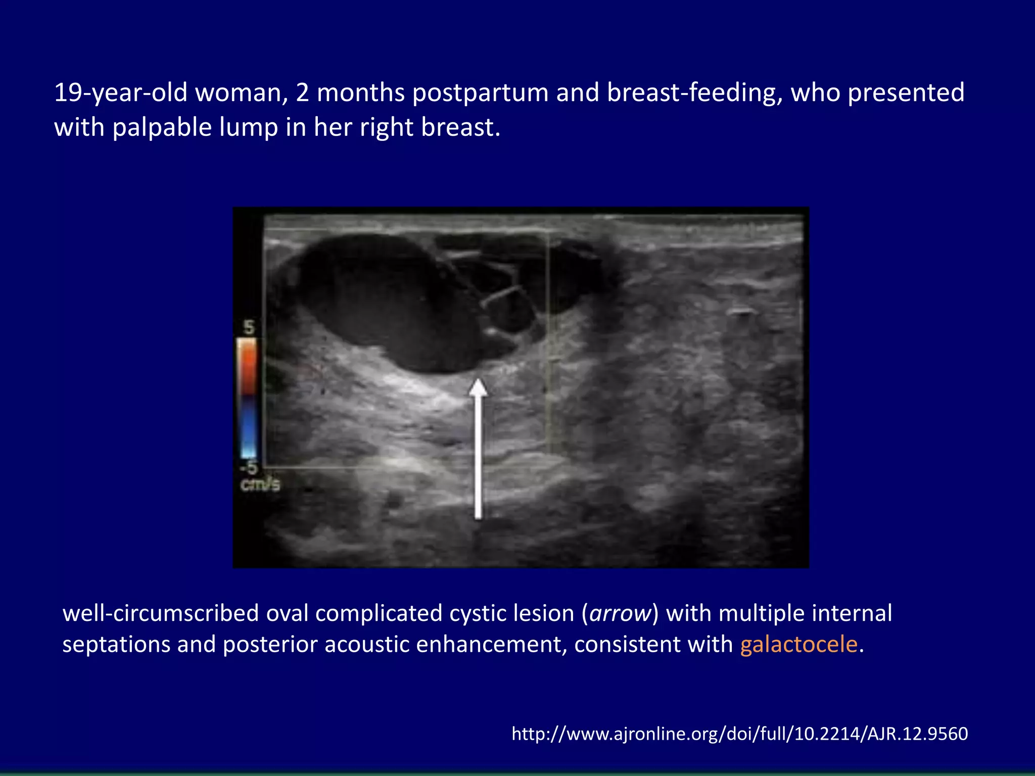 Ultrasound of pediatric and adolescent breast | PPTX