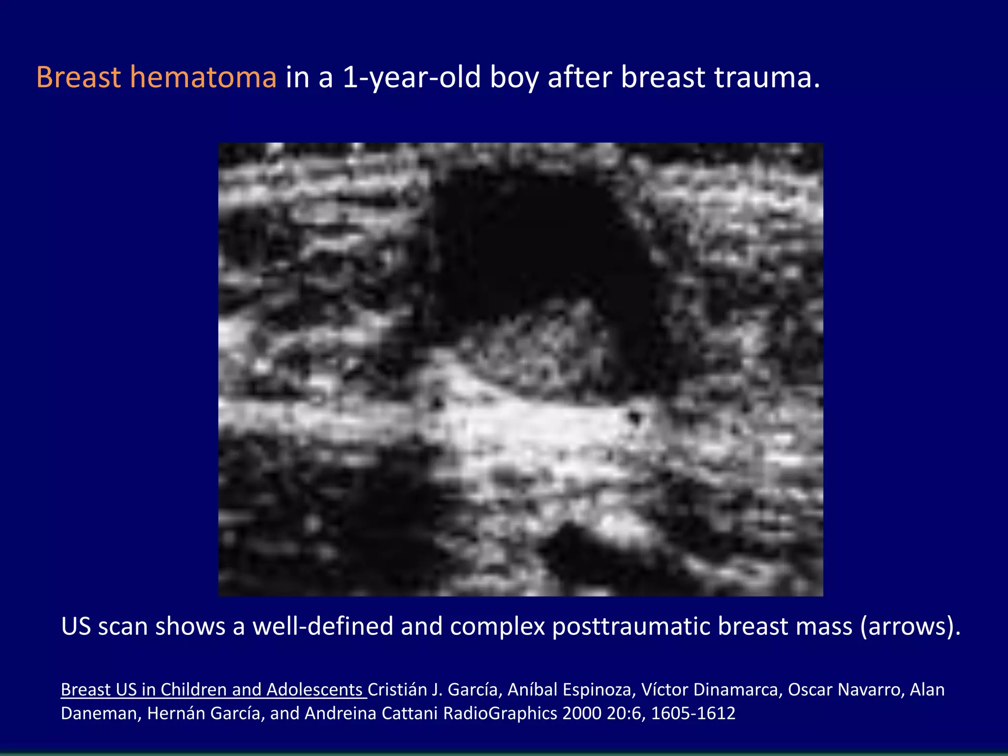 Ultrasound of pediatric and adolescent breast | PPTX
