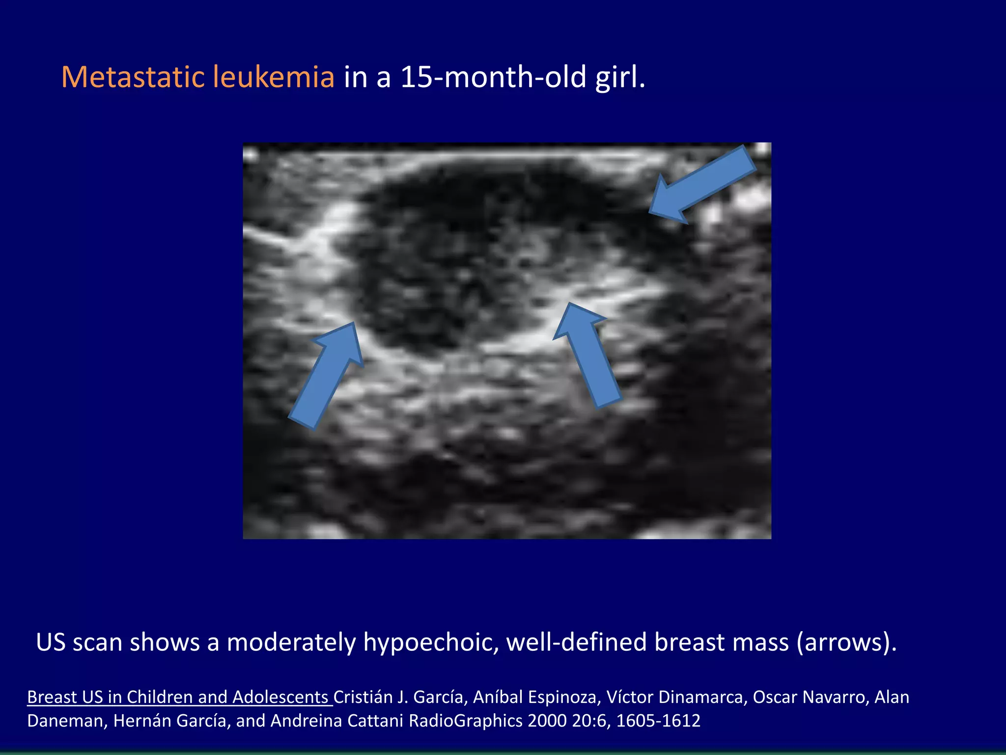 Ultrasound of pediatric and adolescent breast | PPTX