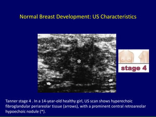 Ultrasound of pediatric and adolescent breast | PPTX