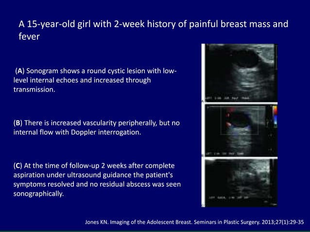 Ultrasound of pediatric and adolescent breast | PPTX
