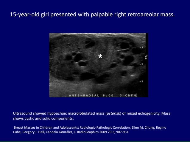 Ultrasound of pediatric and adolescent breast | PPTX