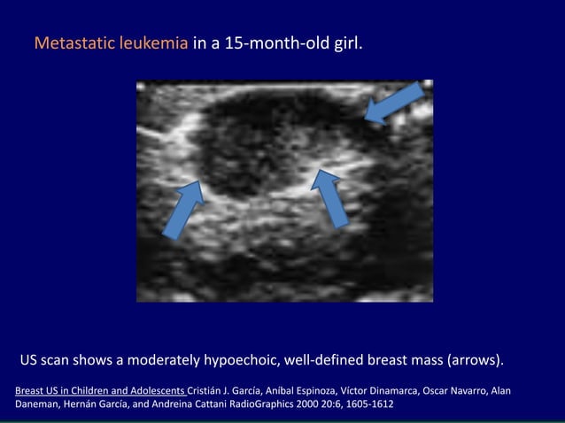 Ultrasound of pediatric and adolescent breast | PPTX