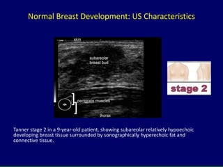 Ultrasound of pediatric and adolescent breast | PPTX