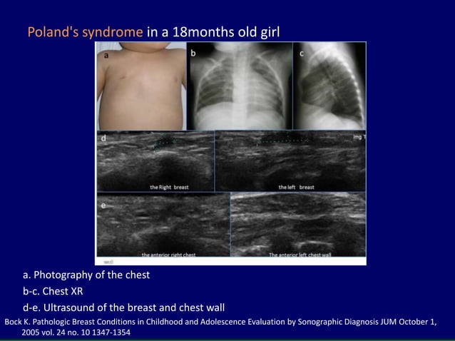 Ultrasound of pediatric and adolescent breast