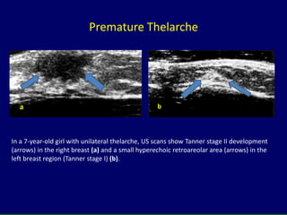 Ultrasound of pediatric and adolescent breast | PPT