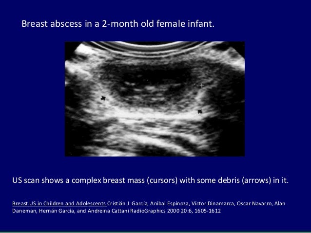 Ultrasound of pediatric and adolescent breast