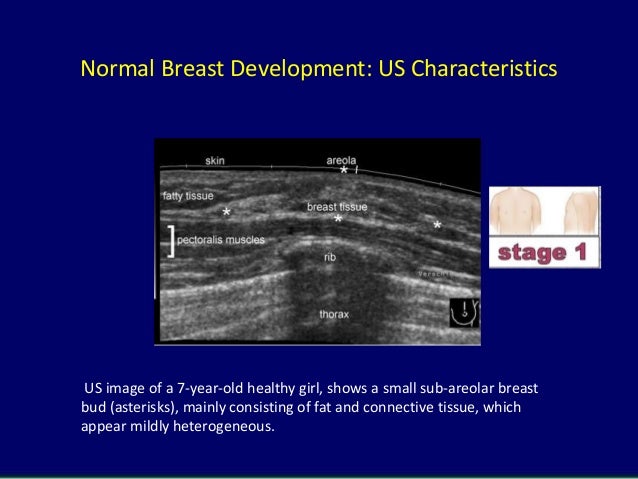 Ultrasound of pediatric and adolescent breast