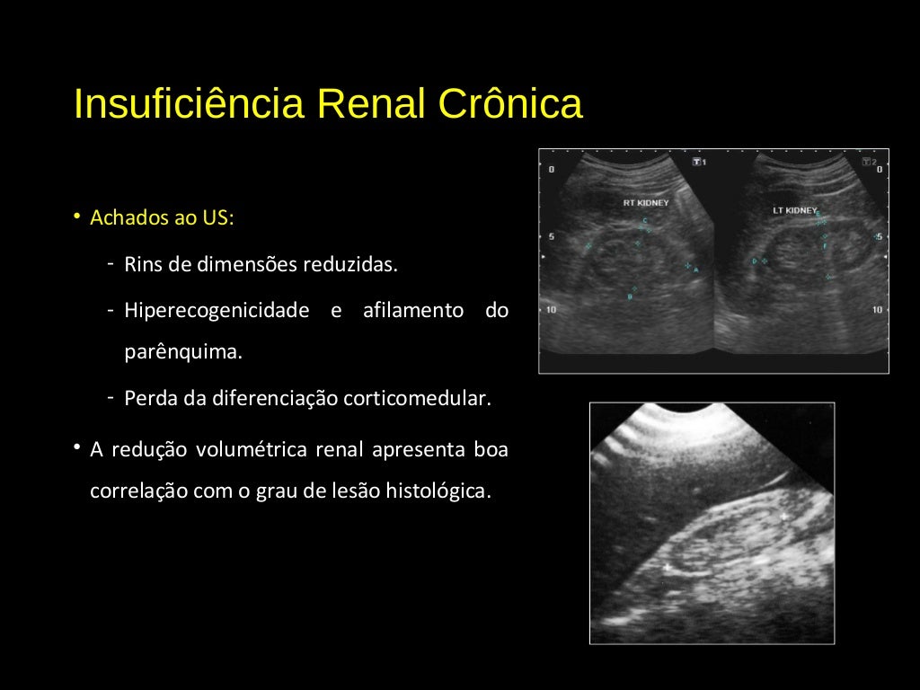 Imagens Hiperecogênicas Nos Rins - RETOEDU