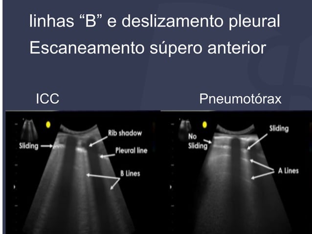 Ultrassom pulmonar `POCUS