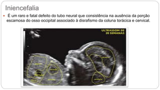 Ultrassonografia morfológica e malformações do sistema nervoso central ...