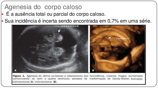 Ultrassonografia morfológica e malformações do sistema nervoso central