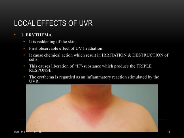 Ultra violet radiation physiotherapy | PDF