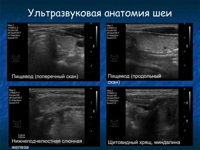 ultrazvukovaya-diagnostika-zabolevaniy-organov-shei-i-shchitovidnoy-zhelezy.pptx