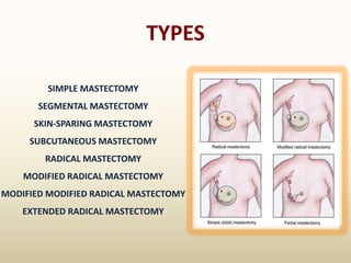 Mastectomy and Breast Cancer | PPTX