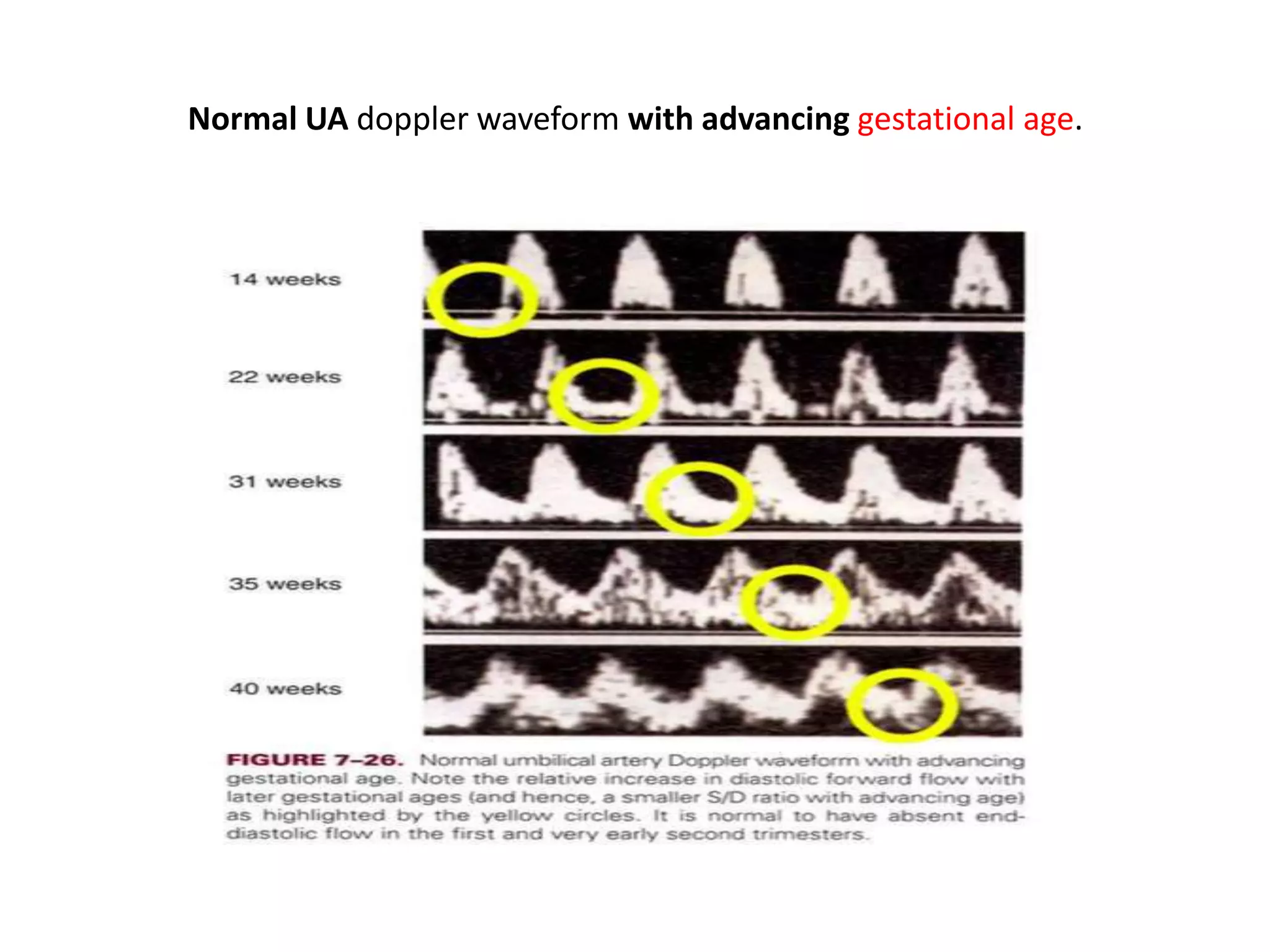 Umbilical artery doppler [1] | PPTX