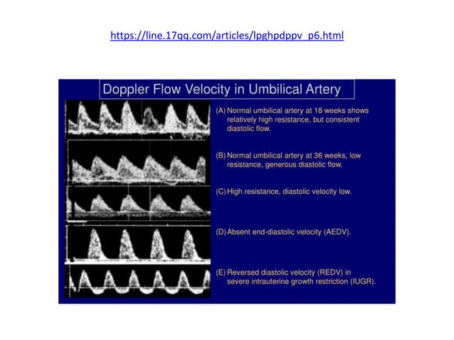 Umbilical artery doppler [1] | PPTX | Pregnancy | Reproductive Health