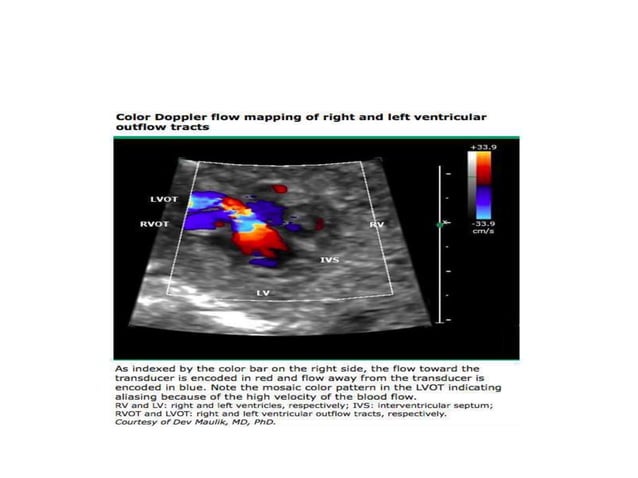 Umbilical artery doppler [1] | PPTX | Pregnancy | Reproductive Health