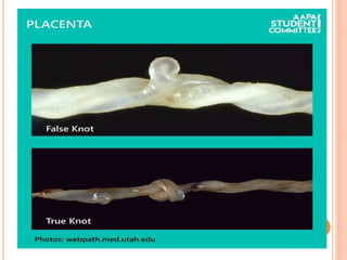 False Knot Umbilical Cord
