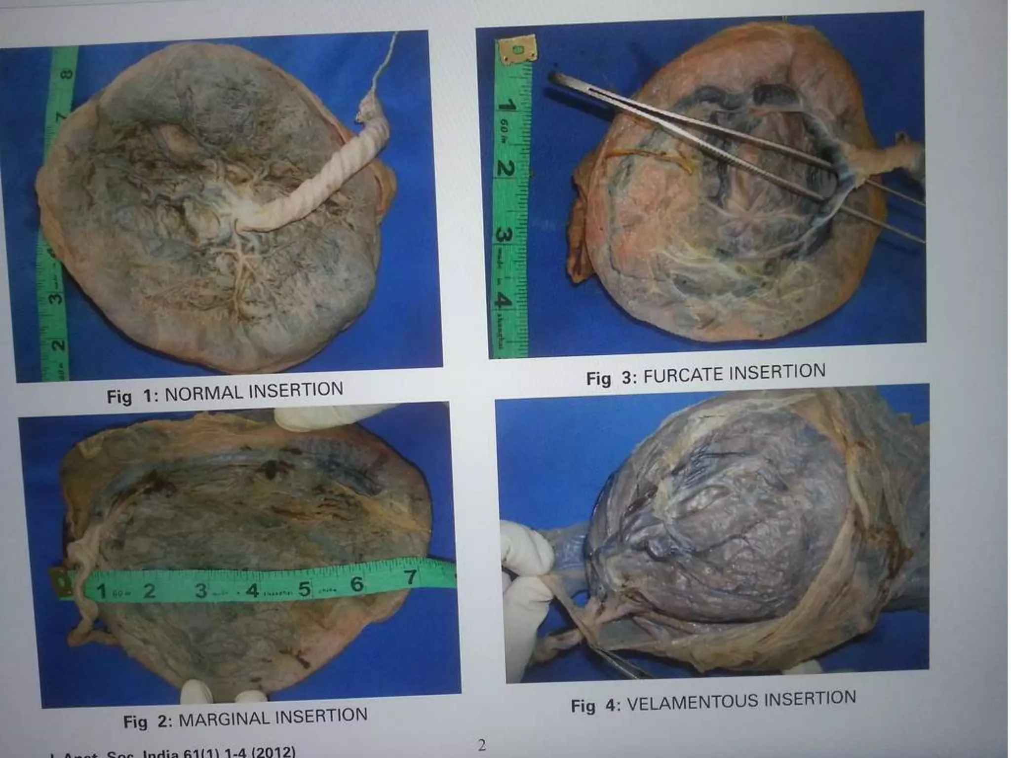 Umbilical cord and cord abnormalities | PPTX