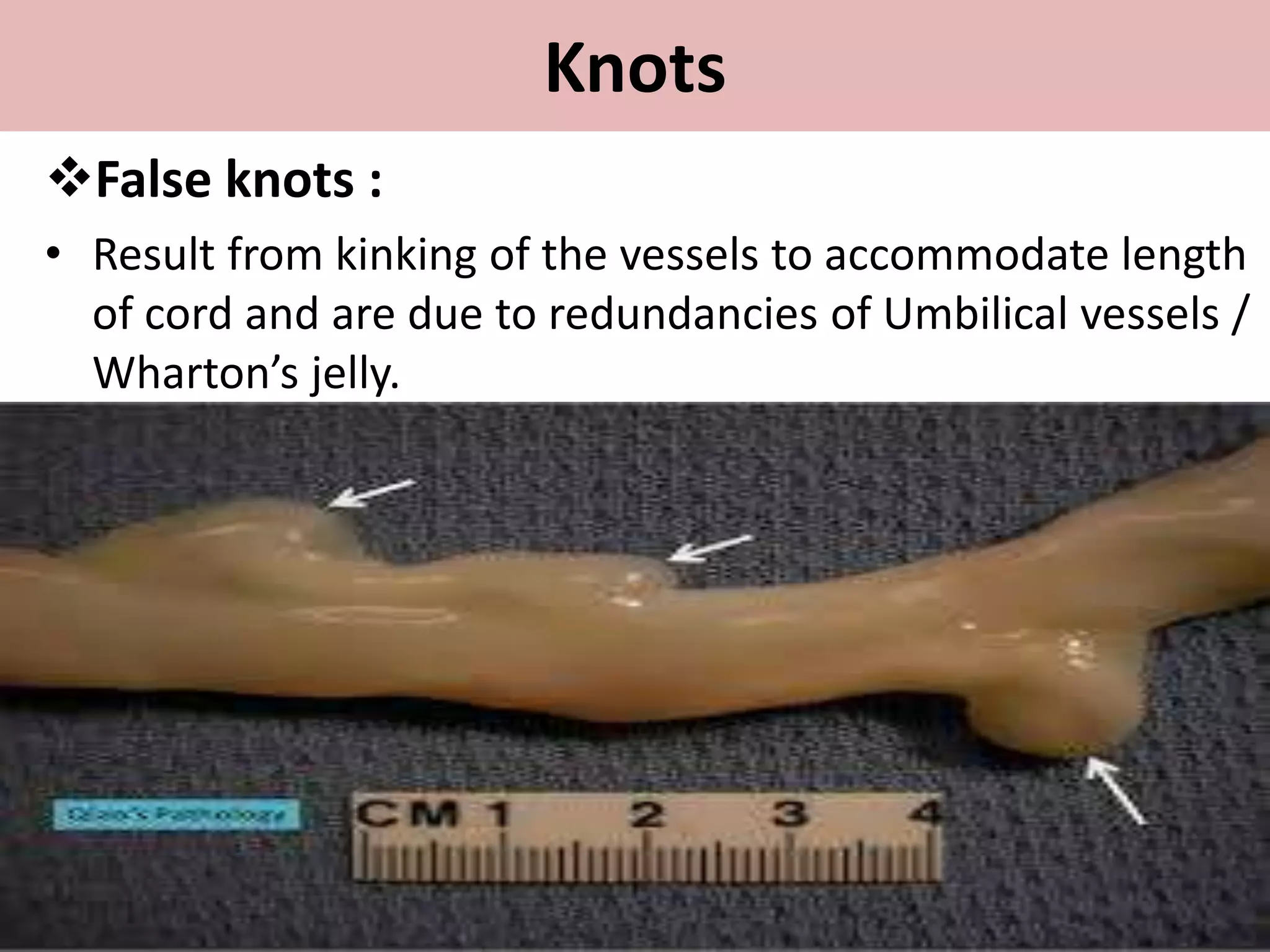 Umbilical cord and cord abnormalities | PPTX