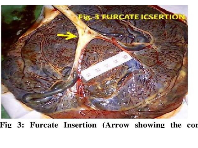 Umbilical cord and cord abnormalities | PPTX