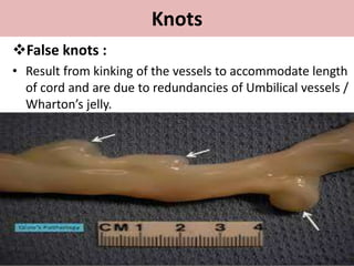 Umbilical cord and cord abnormalities | PPTX