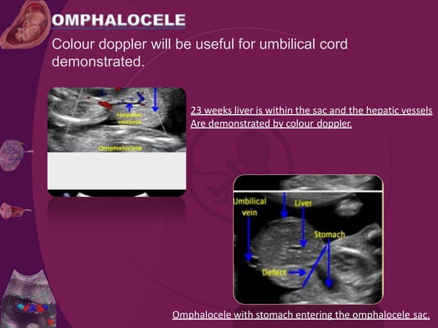 Umbilical cord.pptx