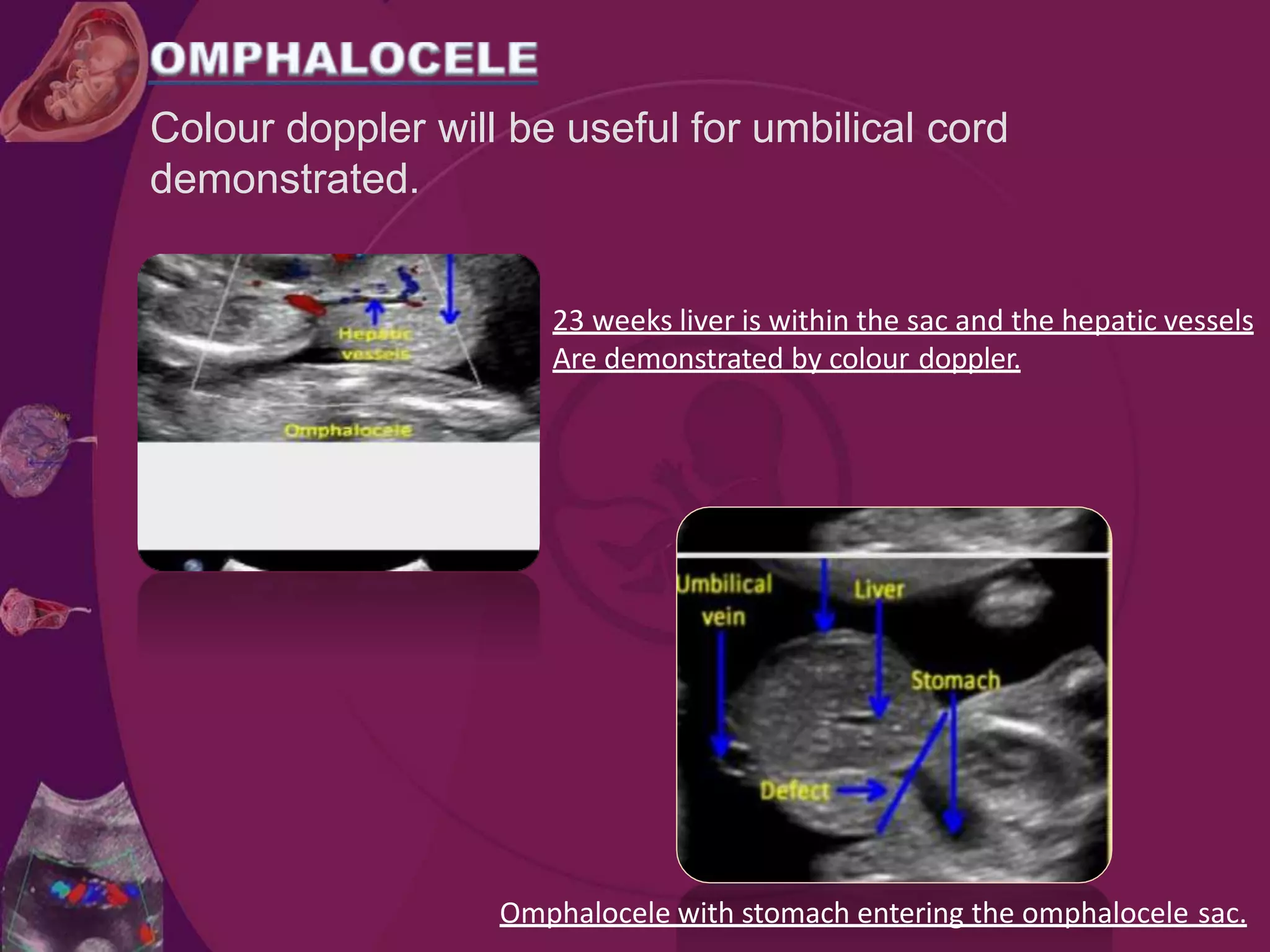 Umbilical cord.pptx