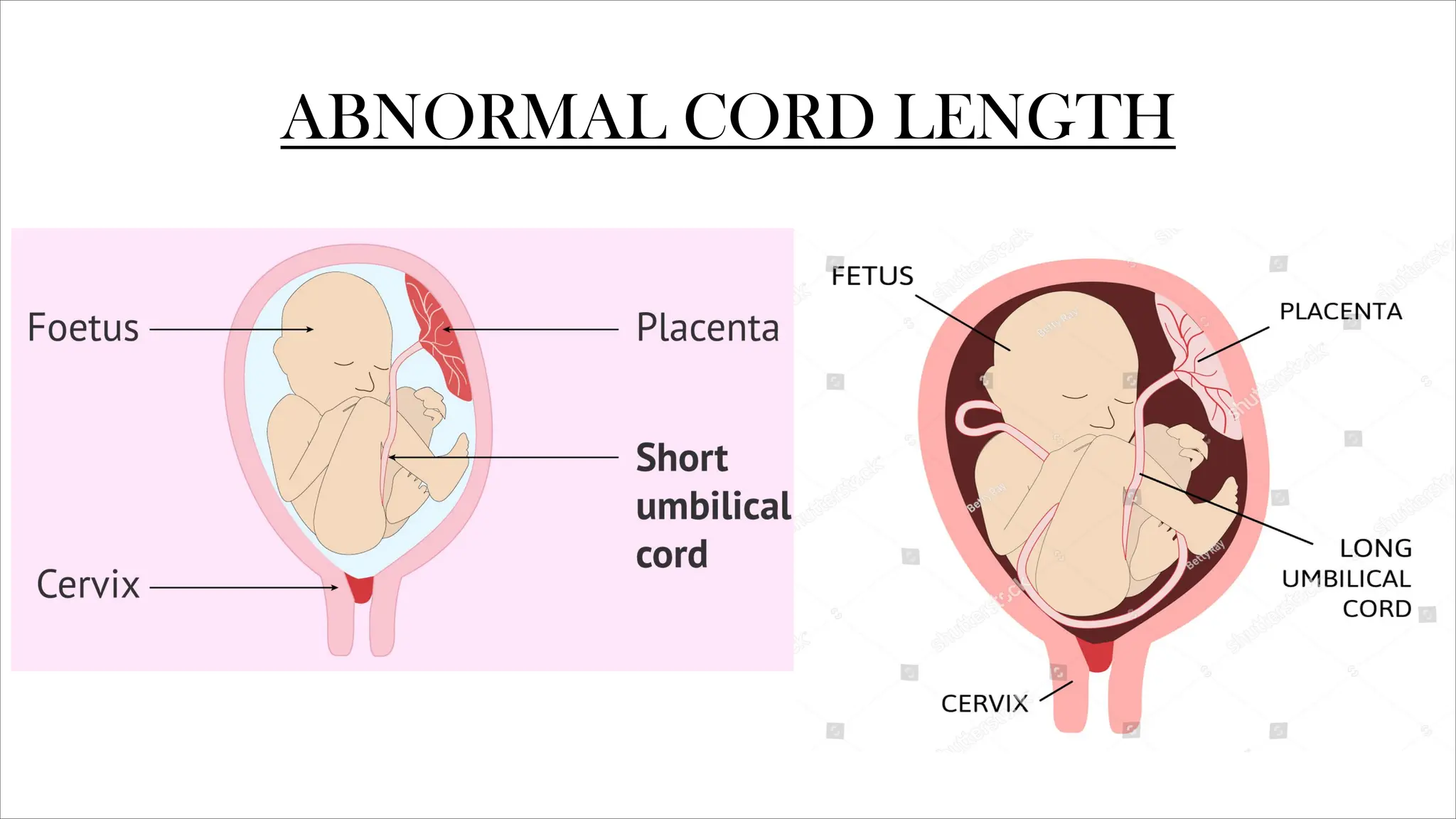 UMBILICAL CORD deformities -Dr. ARCHANA ASOK.pdf