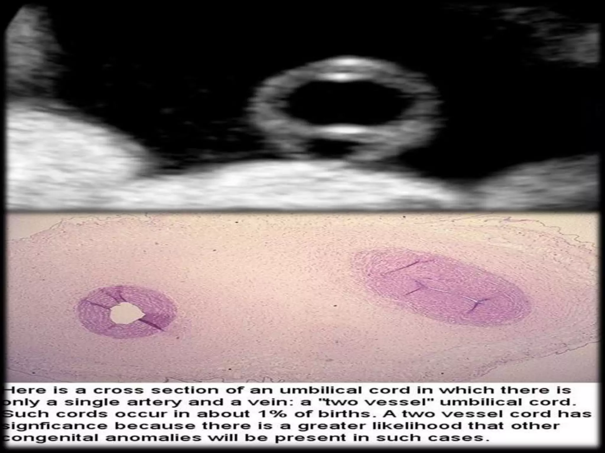 UMBILICAL CORD ABNORMALITIES & ITS OBSTETRIC OUTCOME BY DR SHASHWAT ...