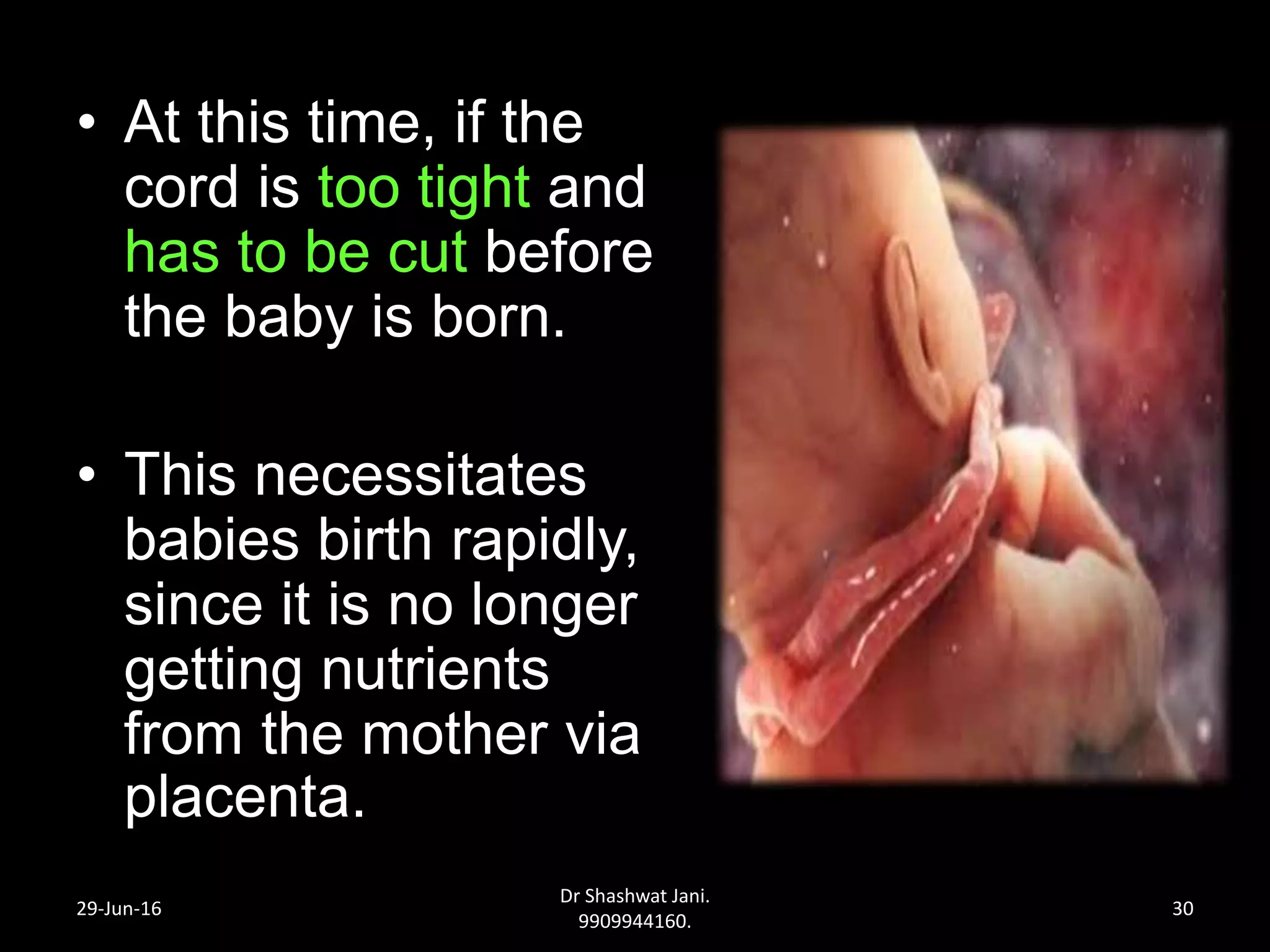 UMBILICAL CORD ABNORMALITIES & ITS OBSTETRIC OUTCOME BY DR SHASHWAT ...