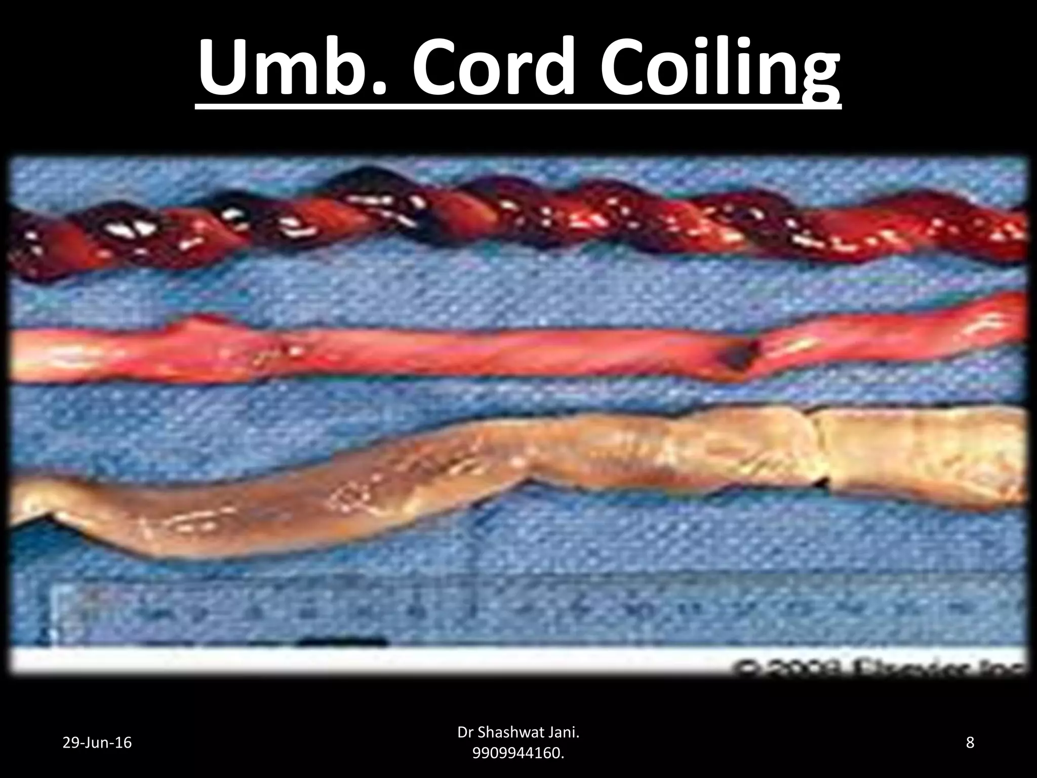 UMBILICAL CORD ABNORMALITIES & ITS OBSTETRIC OUTCOME BY DR SHASHWAT ...