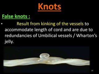 False Knot Umbilical Cord