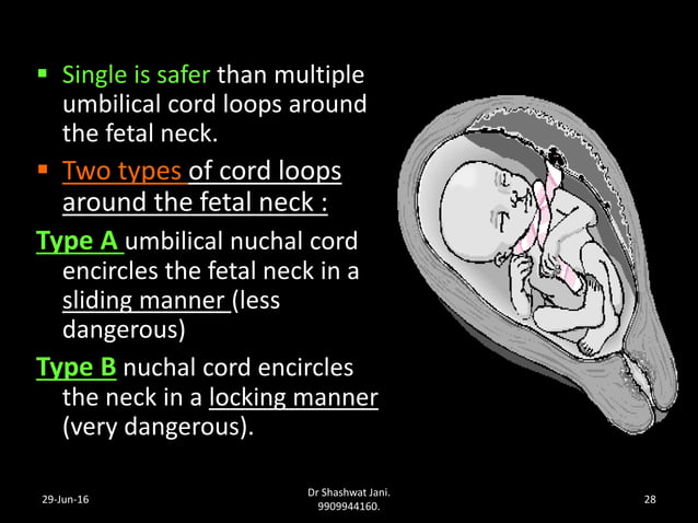 UMBILICAL CORD ABNORMALITIES & ITS OBSTETRIC OUTCOME BY DR SHASHWAT JANI