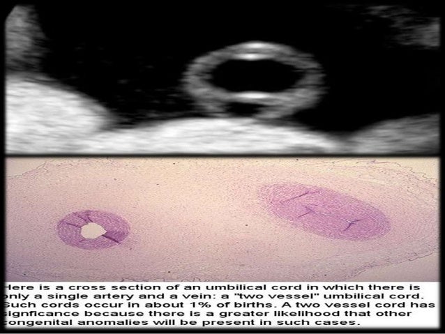 UMBILICAL CORD ABNORMALITIES & ITS OBSTETRIC OUTCOME BY DR SHASHWAT J…
