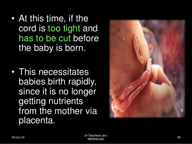 UMBILICAL CORD ABNORMALITIES & ITS OBSTETRIC OUTCOME BY DR SHASHWAT J…