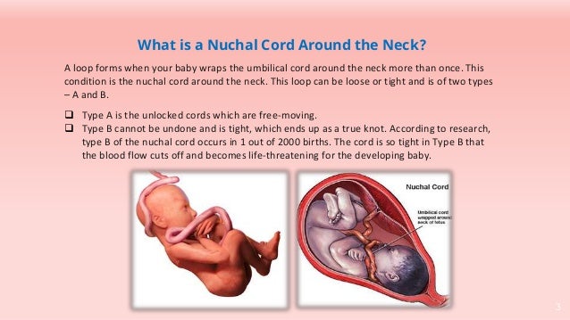 Umbilical Cord Around Neck: Causes, Signs & Remedies