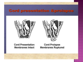 Umbilical cord prolapse - Dr.Suresh Babu Chaduvula | PPTX