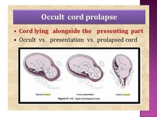 Umbilical cord prolapse - Dr.Suresh Babu Chaduvula | PPTX