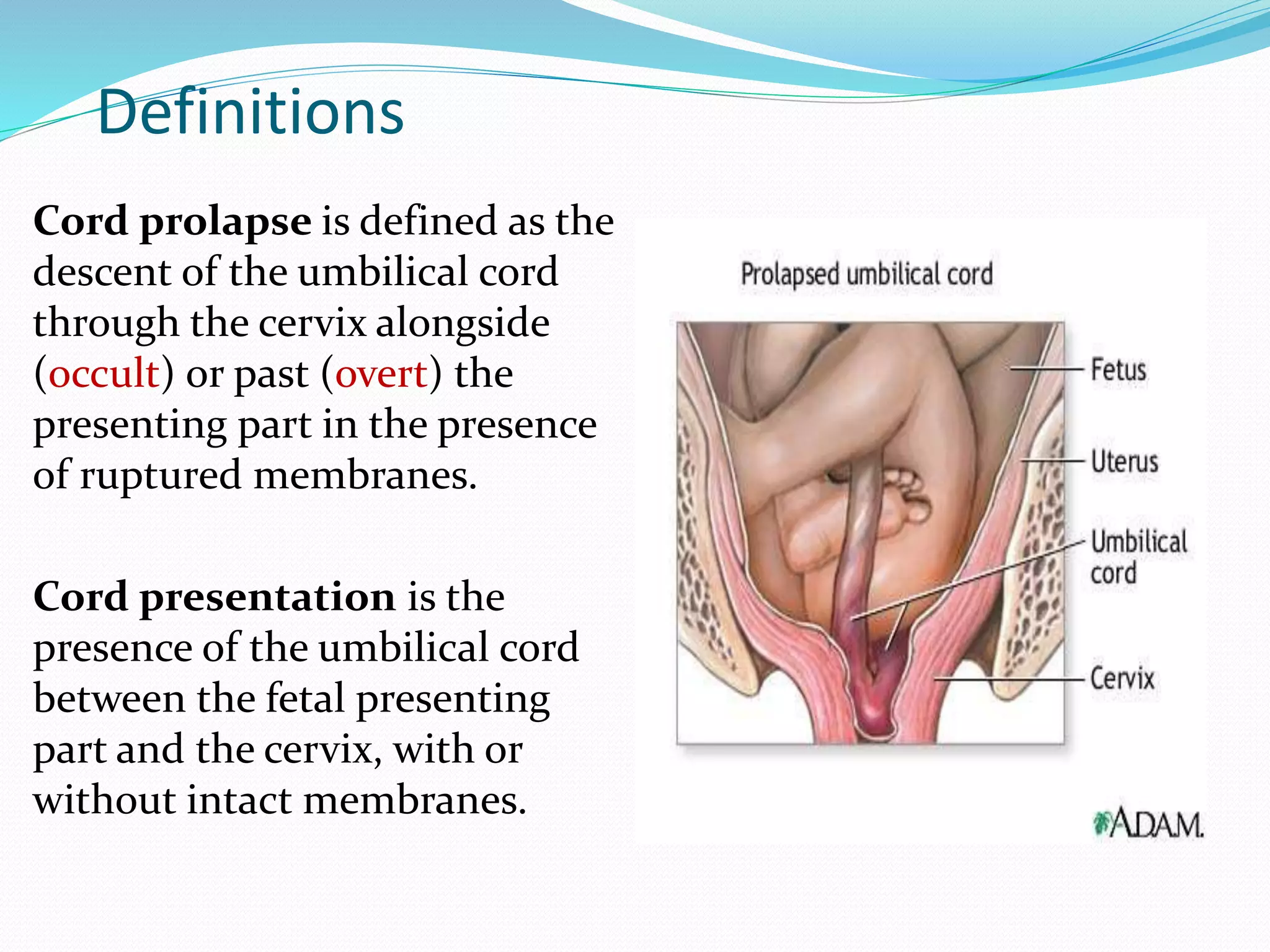 Umbilical cord prolapse | PPTX