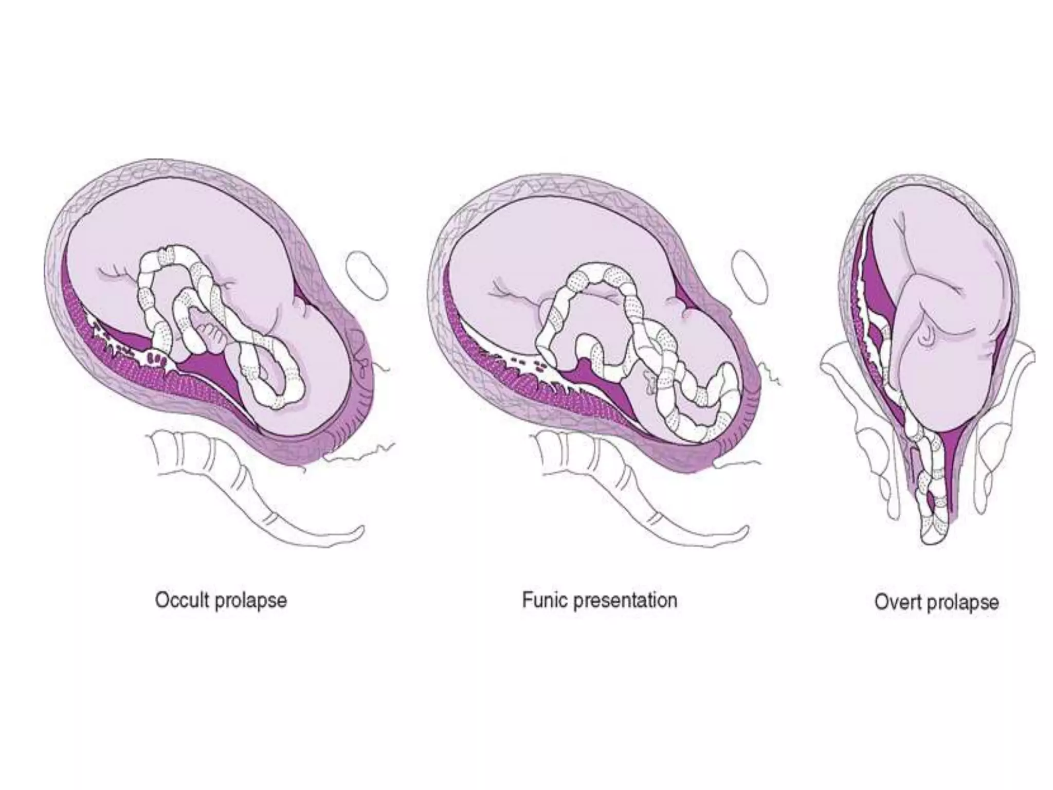 Umbilical cord prolapse | PPTX